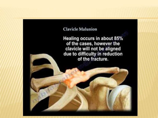 Clavicle Fracture management - what to do | PPT