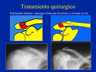 Clavicula fractura | PPT