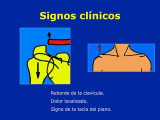 Clavicula fractura | PPT