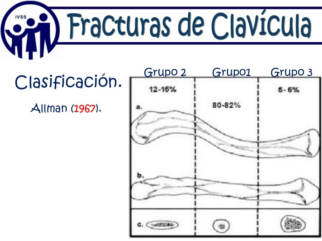 Fracturas Clavicula LG