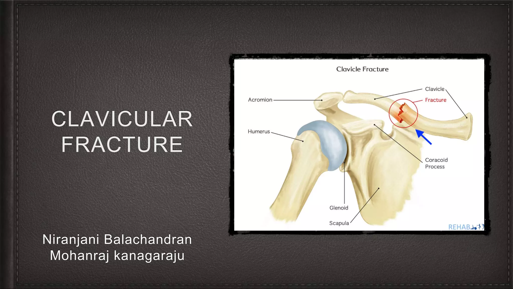 Clavicular fracture .pptx