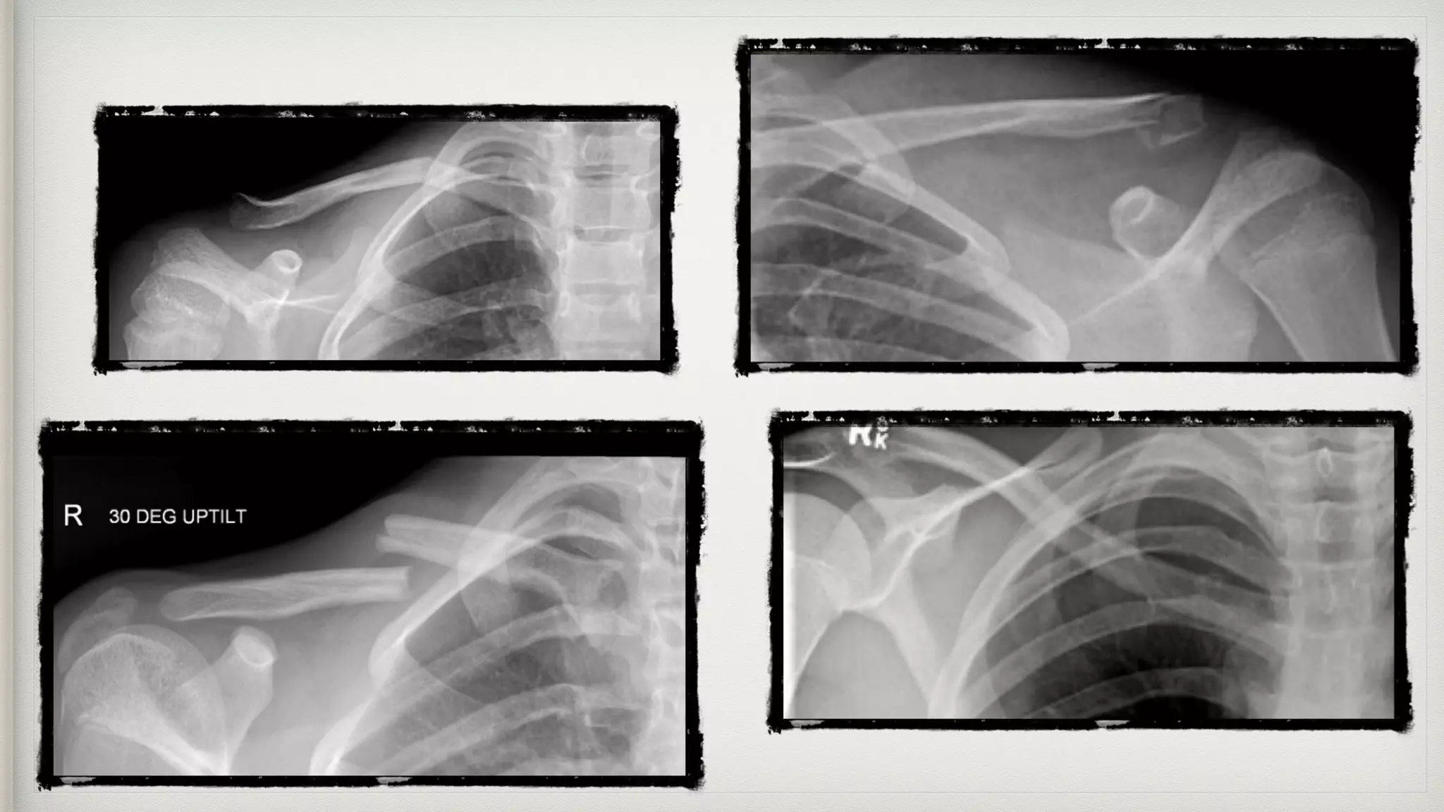 Clavicular fracture .pptx