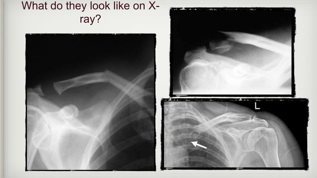 Clavicular fracture .pptx
