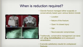 Clavicular fracture .pptx