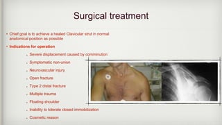 Clavicular fracture .pptx