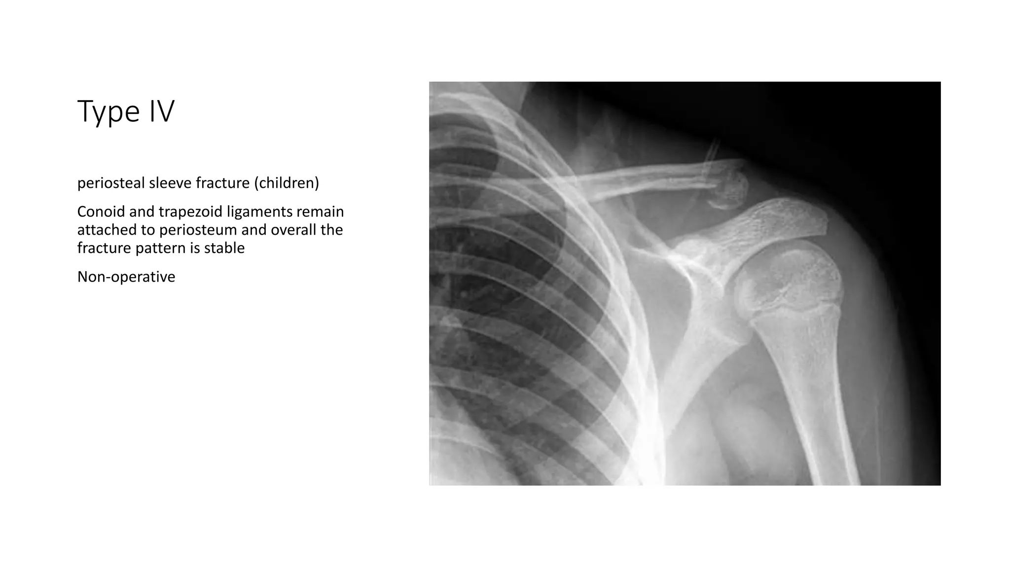 Clavicular fracture & acj injury | PPT