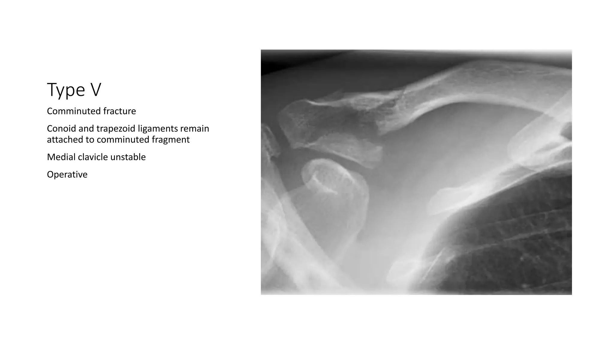 Clavicular fracture & acj injury | PPTX