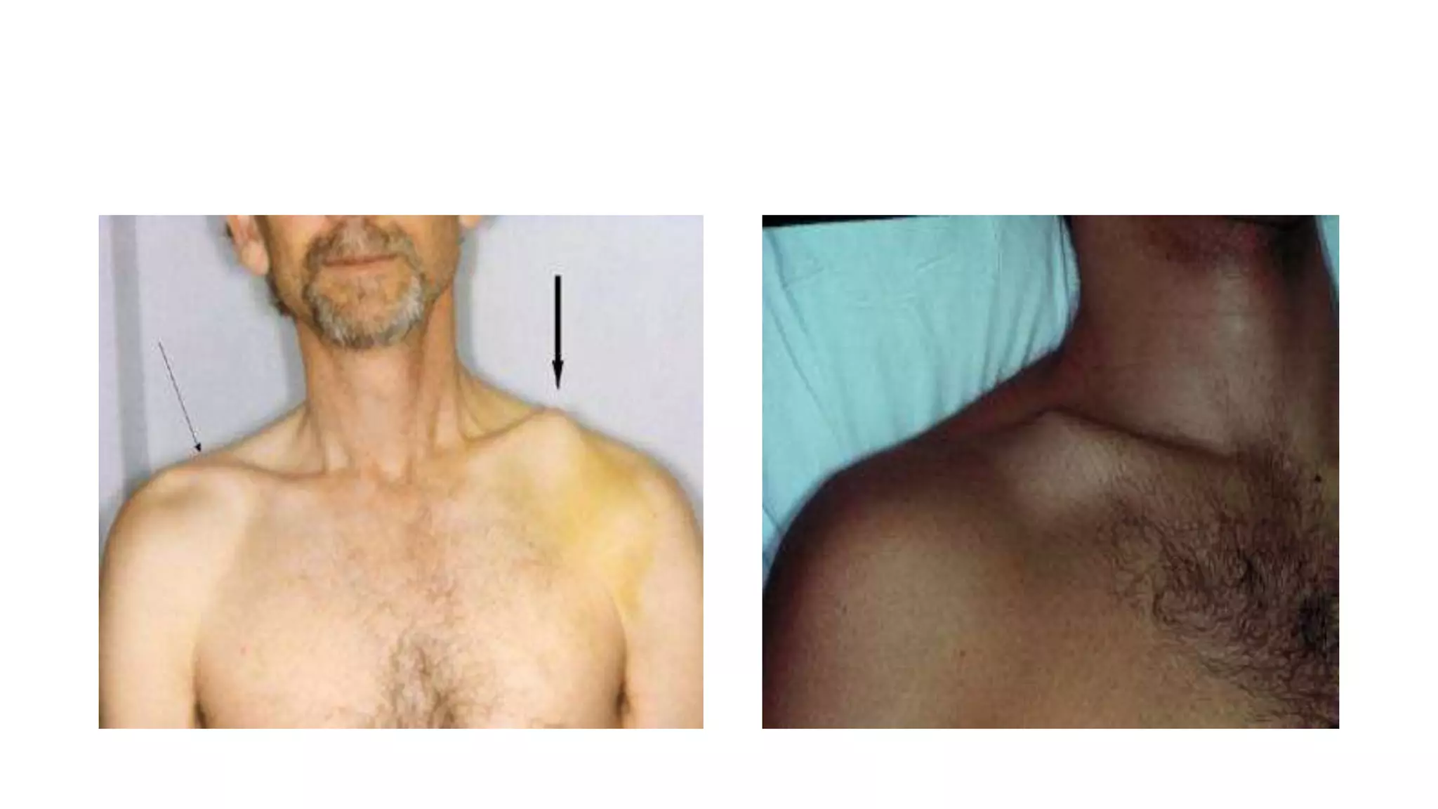 Clavicular fracture & acj injury | PPTX