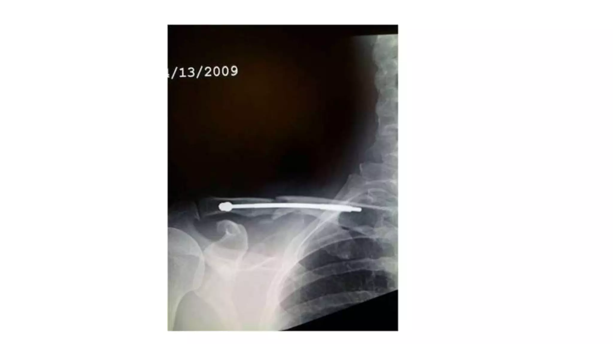 Clavicular fracture & acj injury | PPTX