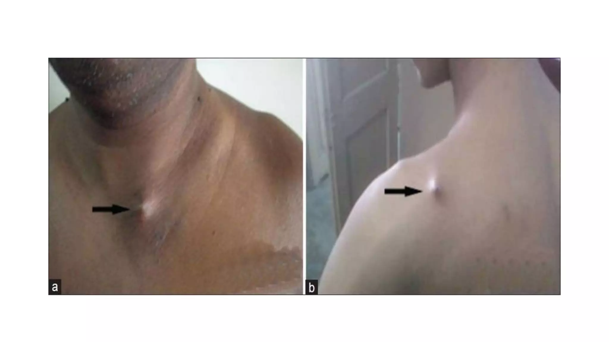 Clavicular fracture & acj injury | PPTX