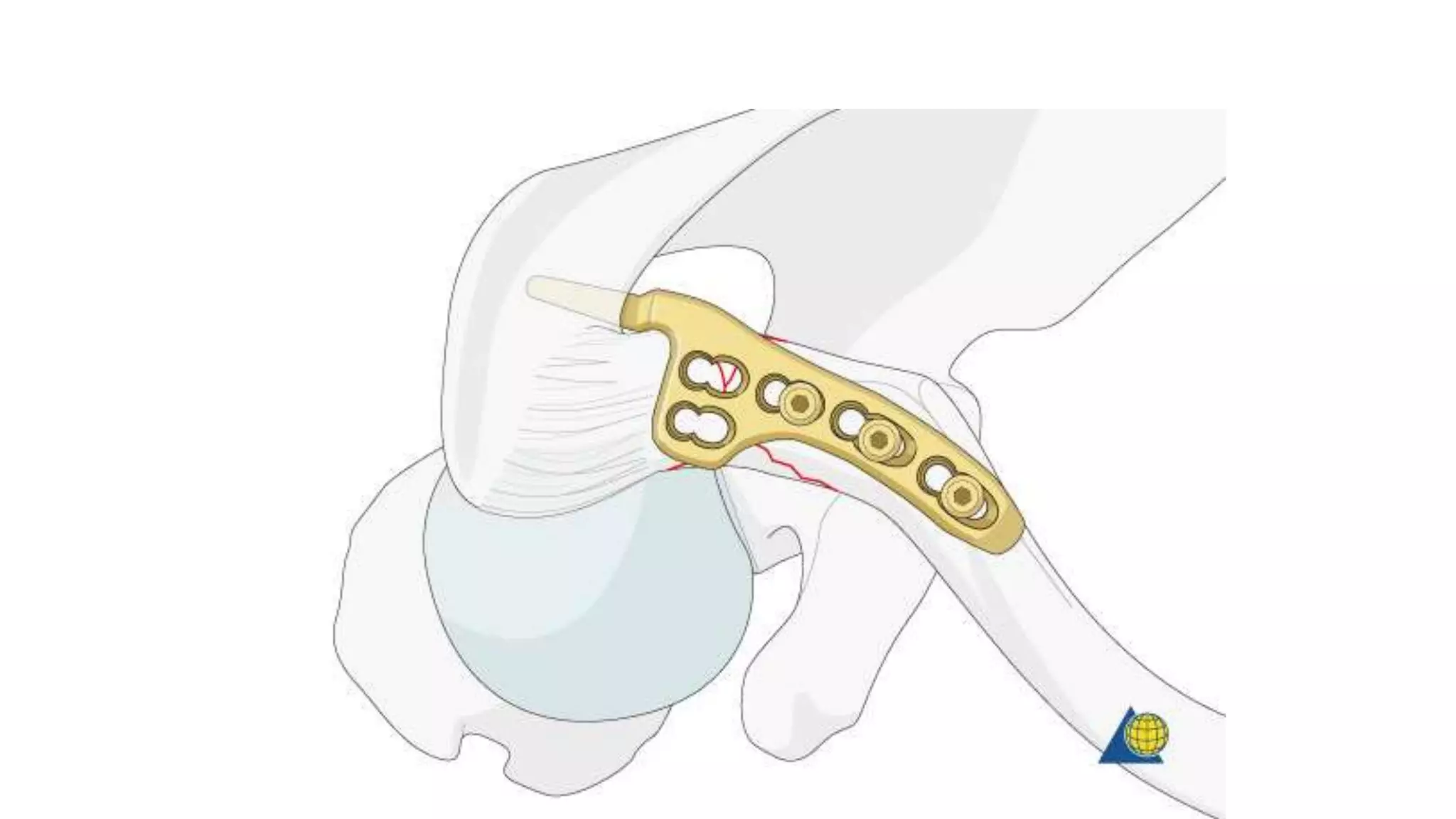 Clavicular fracture & acj injury | PPTX