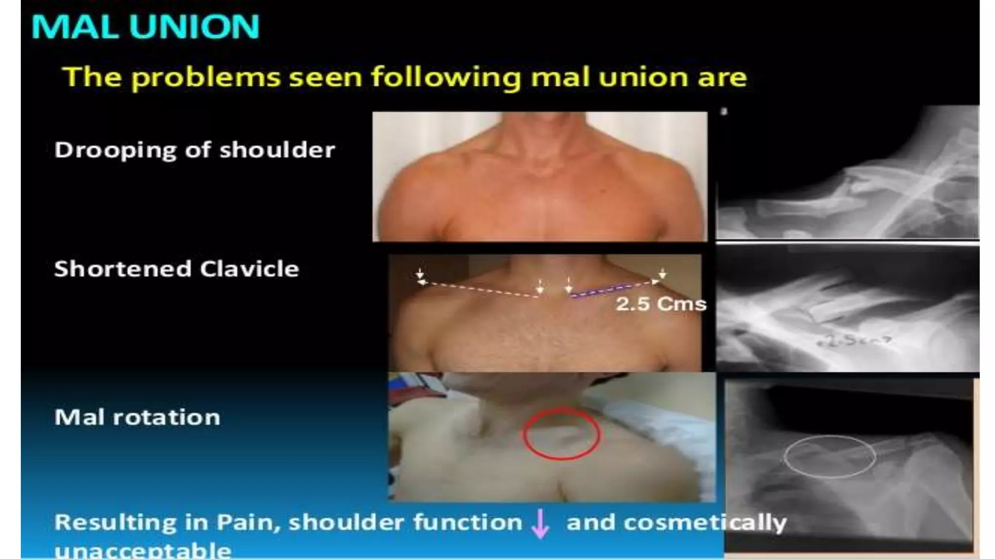Clavicular fracture & acj injury | PPTX