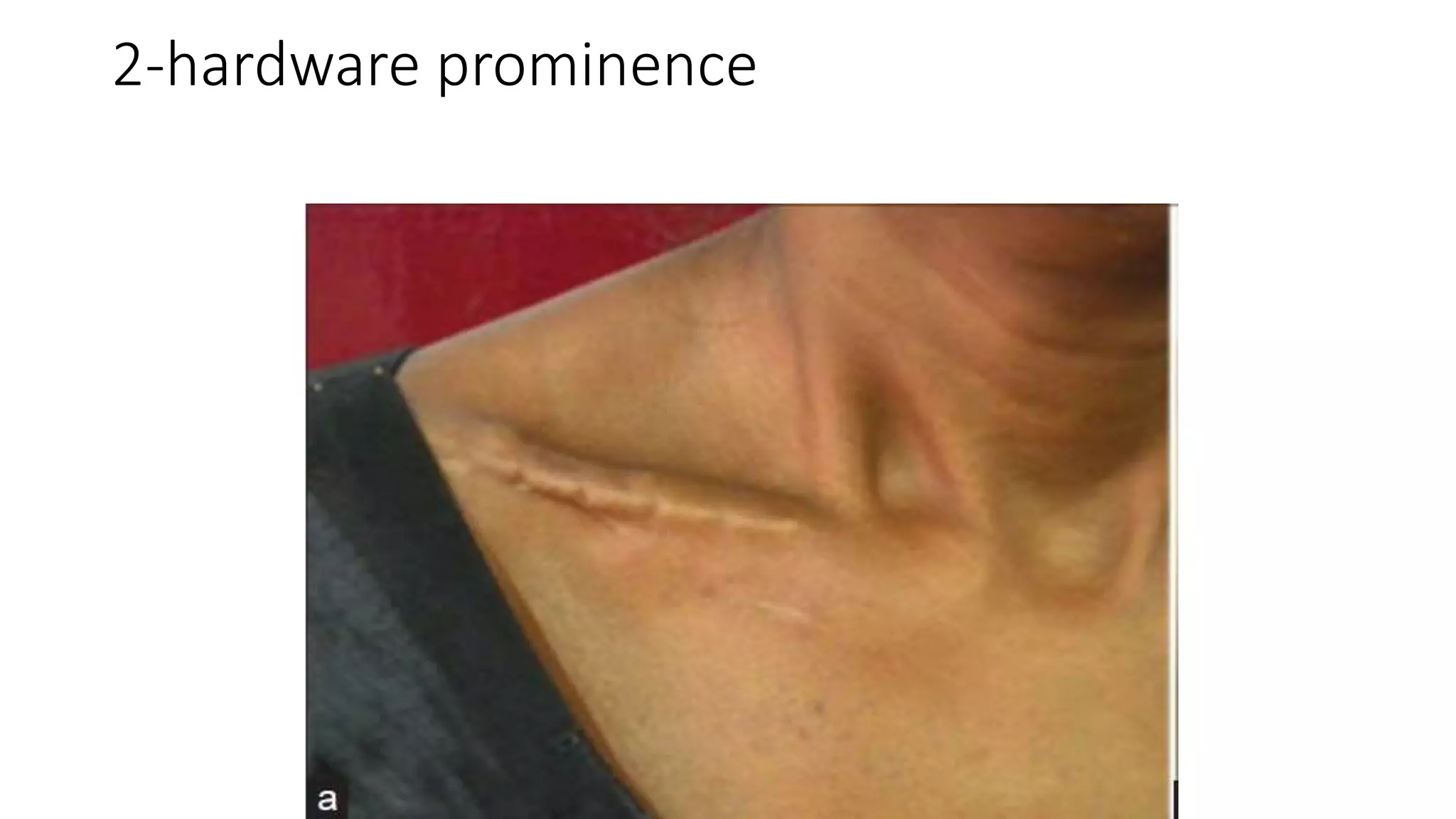 Clavicular fracture & acj injury | PPTX