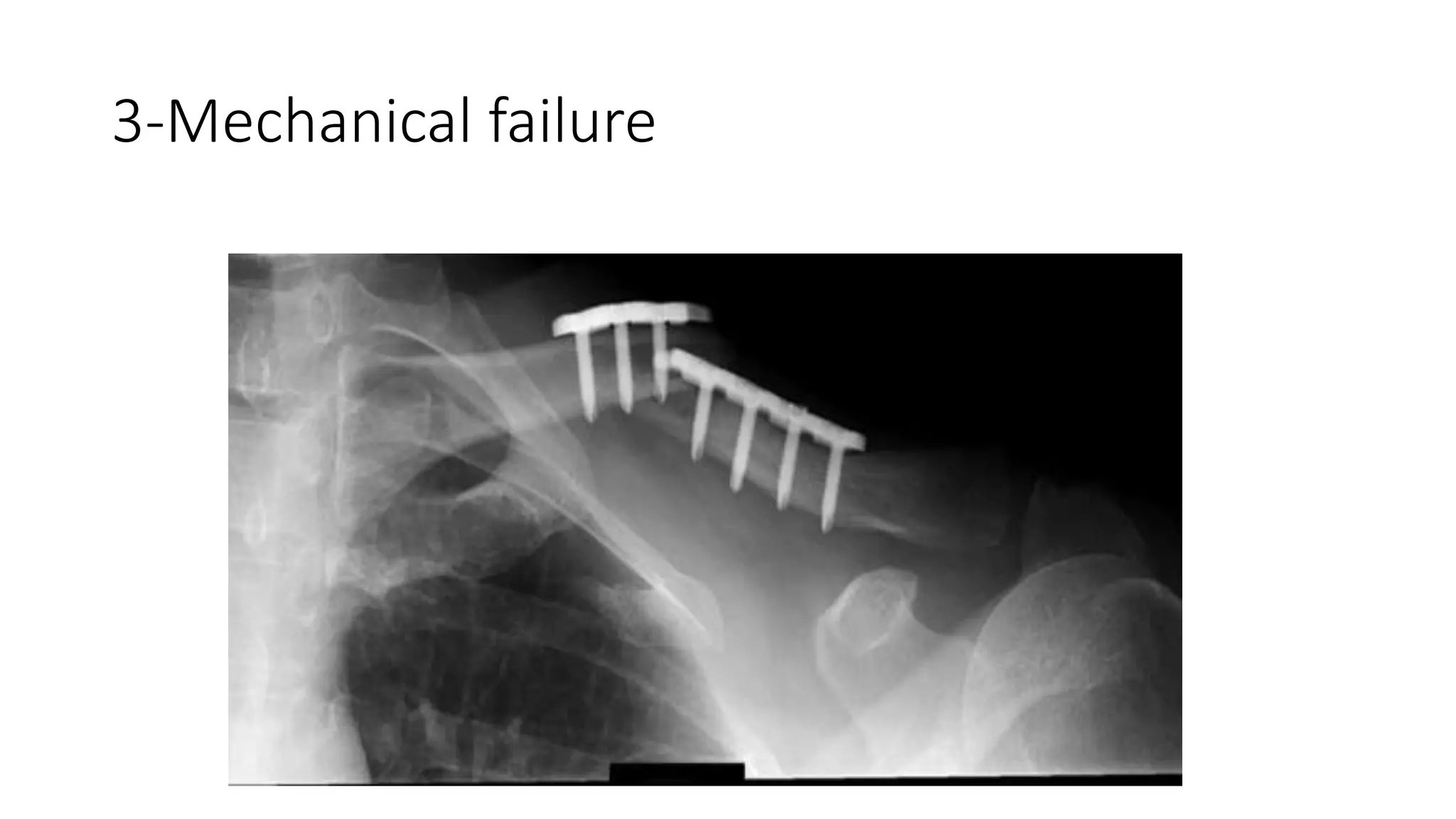 Clavicular fracture & acj injury | PPTX