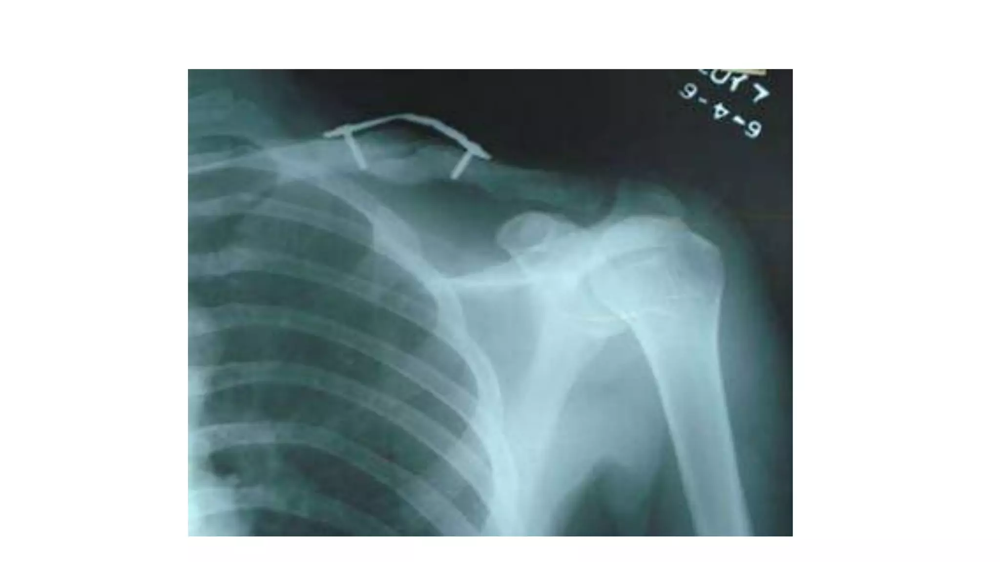Clavicular fracture & acj injury | PPTX