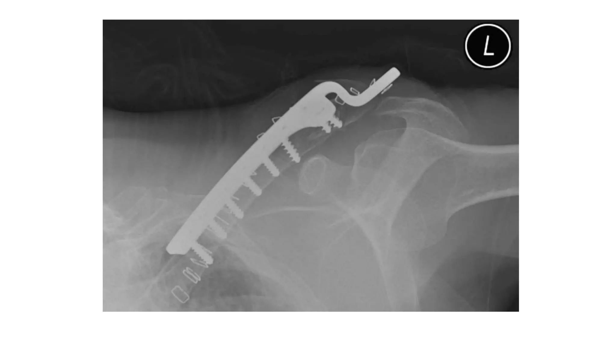 Clavicular fracture & acj injury | PPTX