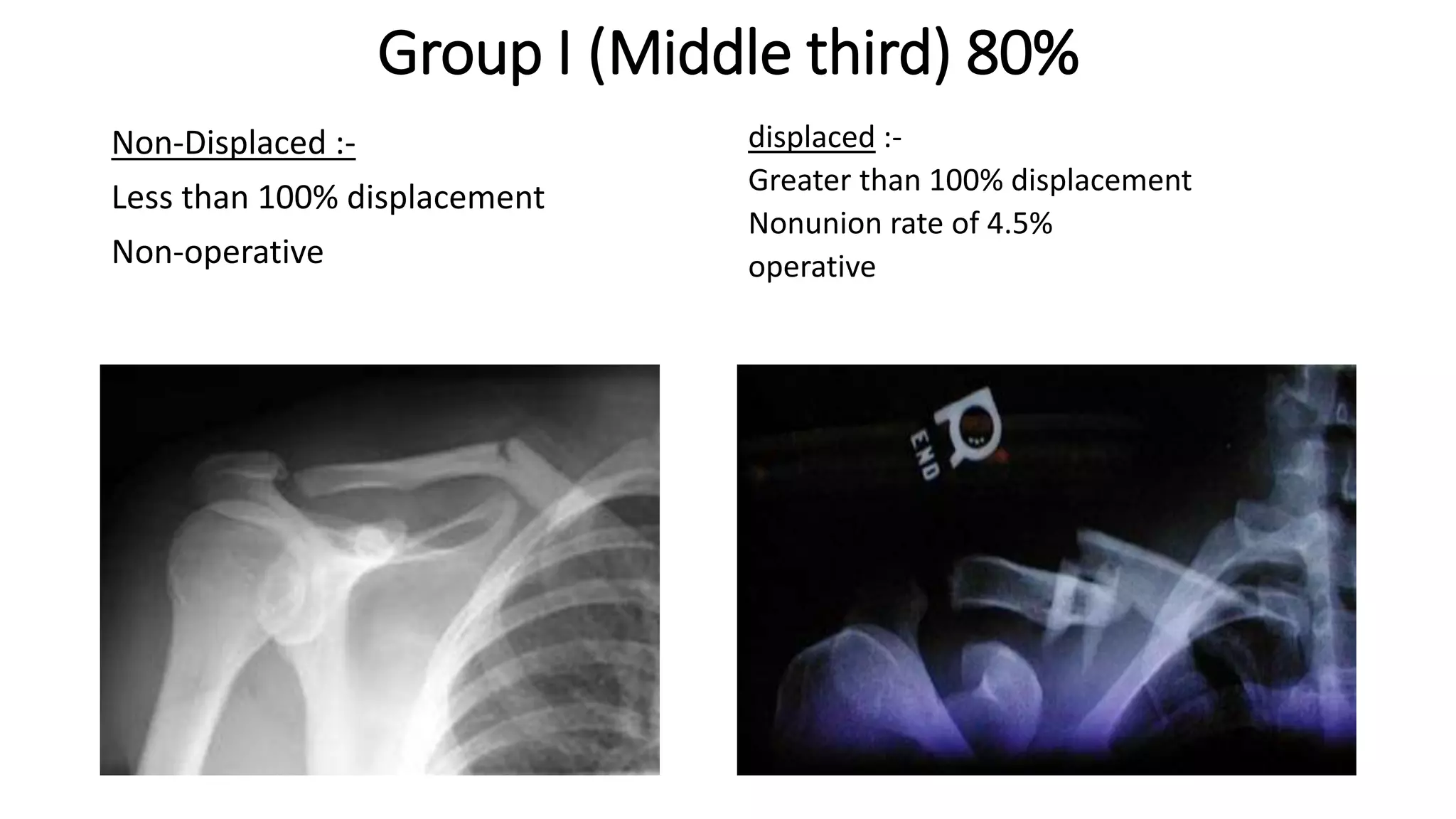 Clavicular fracture & acj injury | PPTX