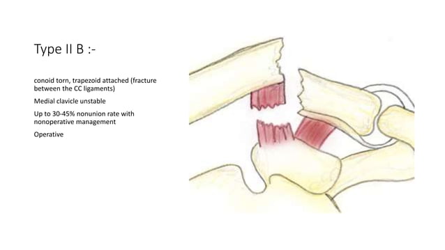 Clavicular fracture & acj injury | PPTX