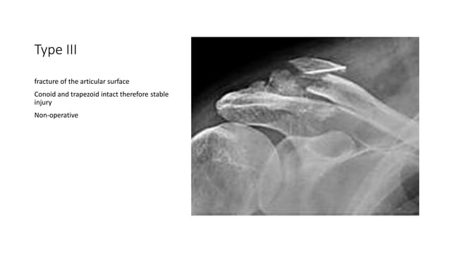 Clavicular fracture & acj injury | PPTX