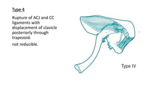 Clavicular fracture & acj injury | PPTX