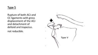 Clavicular fracture & acj injury | PPTX