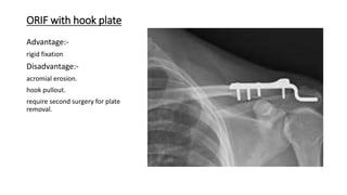 Clavicular fracture & acj injury | PPTX