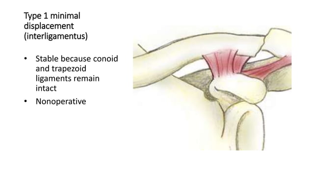 Clavicular fracture & acj injury | PPTX