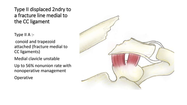 Clavicular fracture & acj injury | PPTX