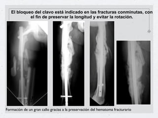 Clavo centromedular | KEY