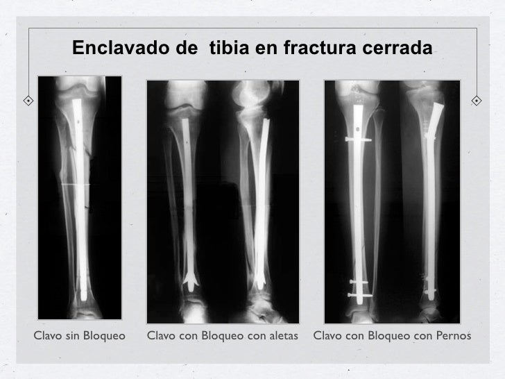 Clavo centromedular