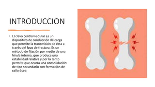 CLAVO CENTROMEDULAR.pptx