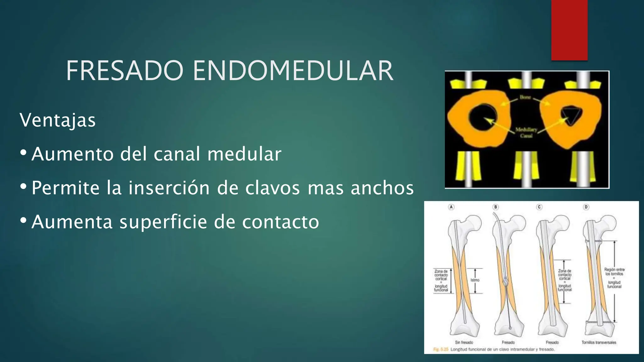 clavo endomedular para fracturas diafisiarias de humero.pptx