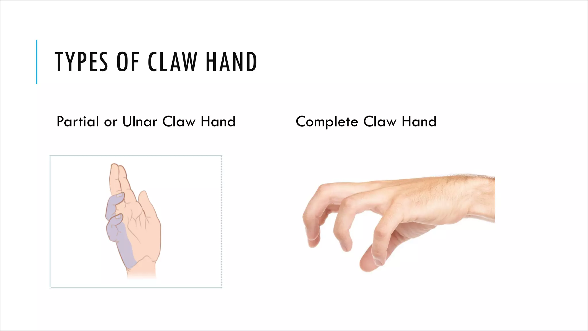 Claw Hand | PDF