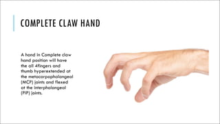 Claw Hand Deformity