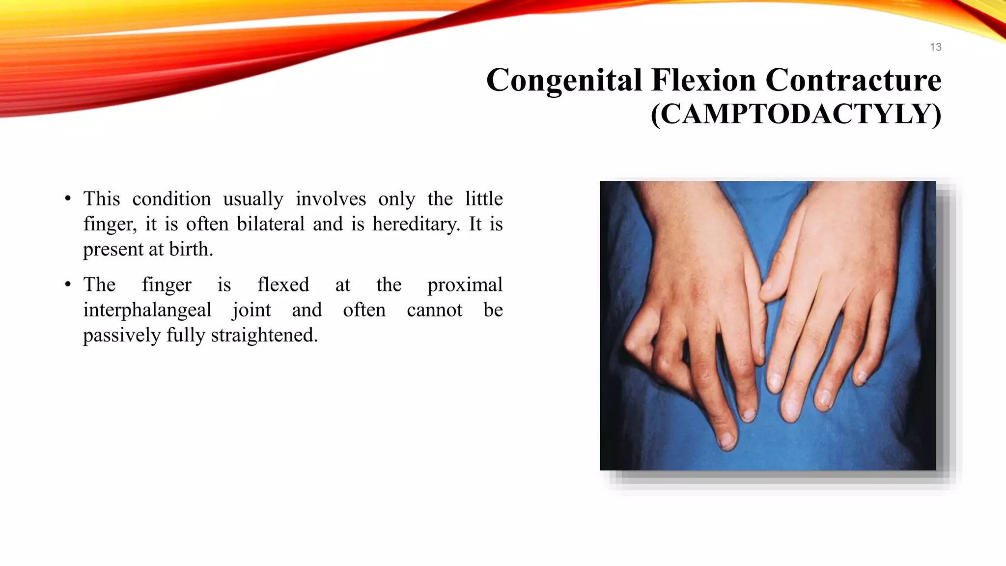 Claw Hand,Definition,Causes,Types,Symptoms and Management | PPTX