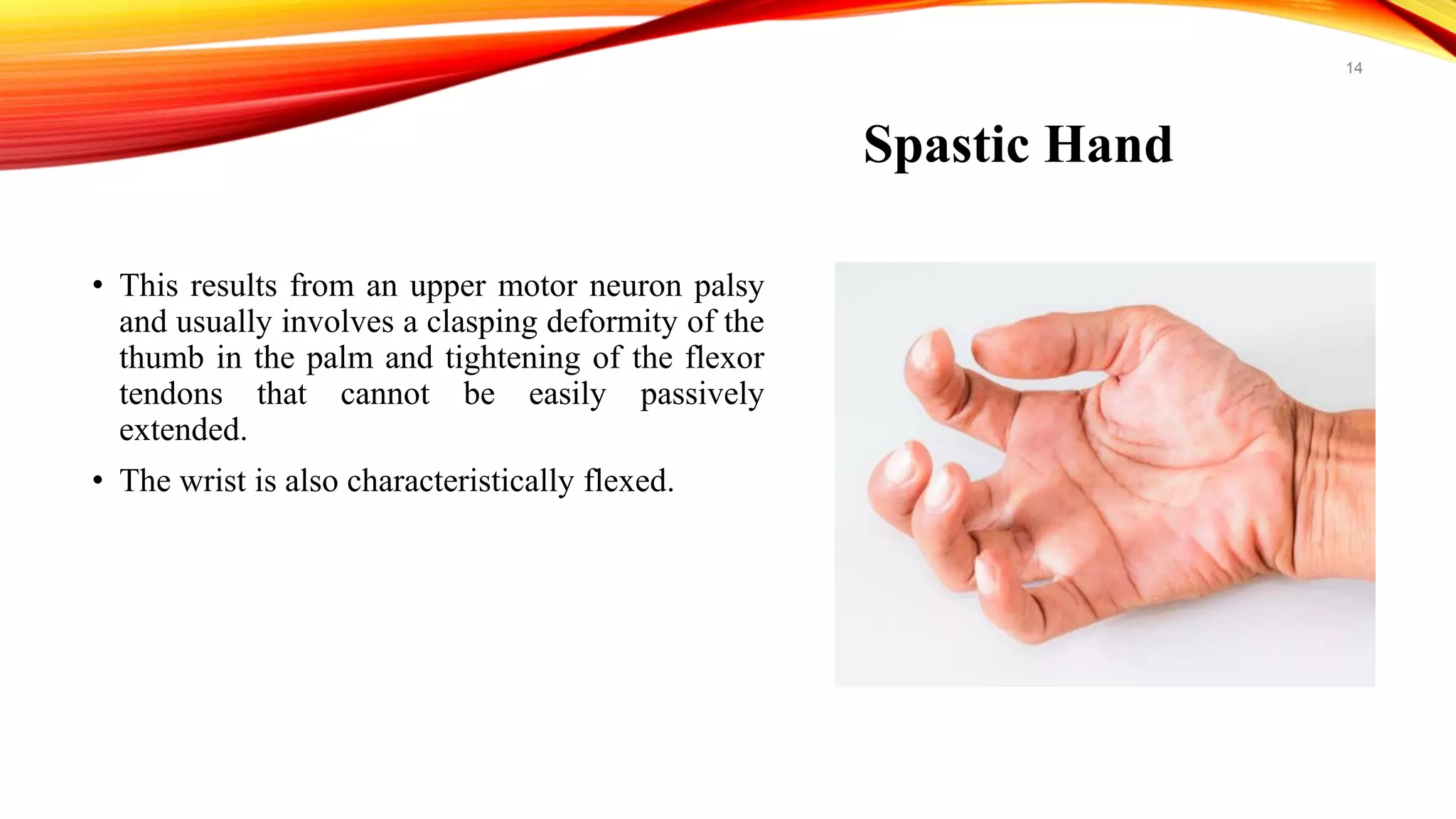 Claw Hand,Definition,Causes,Types,Symptoms and Management | PPTX