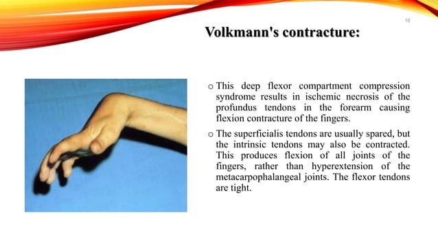 Claw Hand,Definition,Causes,Types,Symptoms and Management | PPTX ...