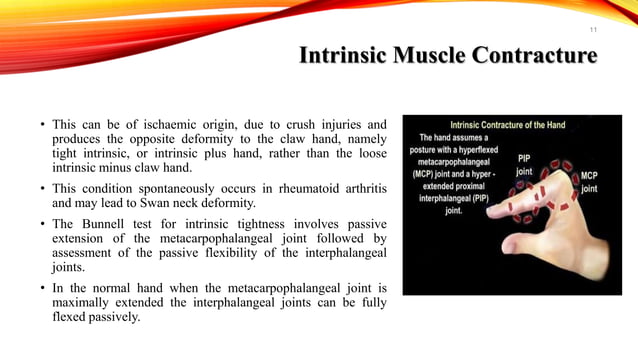 Claw Hand,Definition,Causes,Types,Symptoms and Management