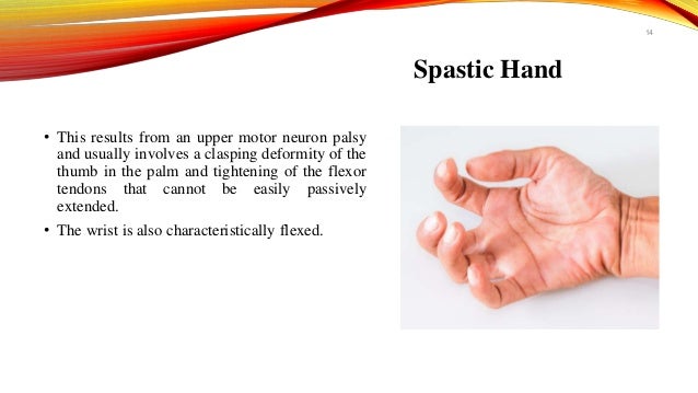 Claw hand,causes,types,symptoms,management