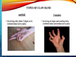 Ulnar Claw Hand