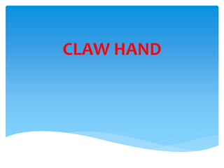Claw hand dr akbar | PPT