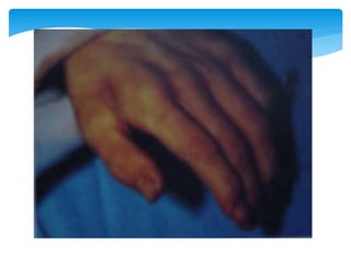 Claw hand dr akbar | PPT