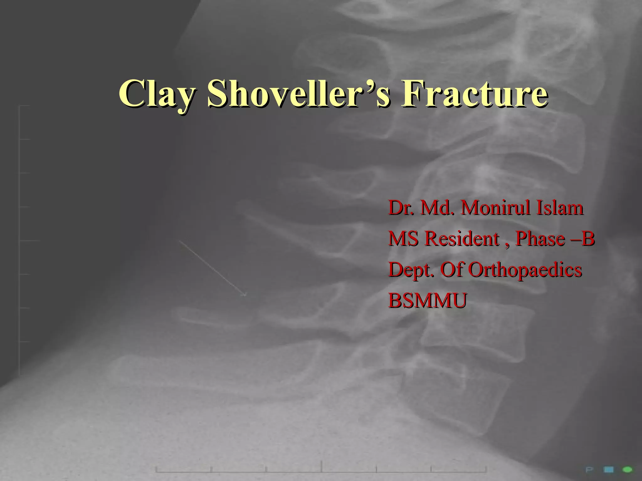 Clay shoveler's fracture | PPT