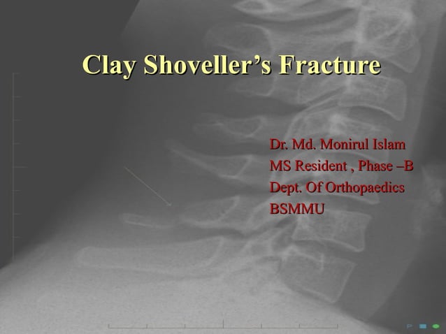 Clay shoveler's fracture | PPT