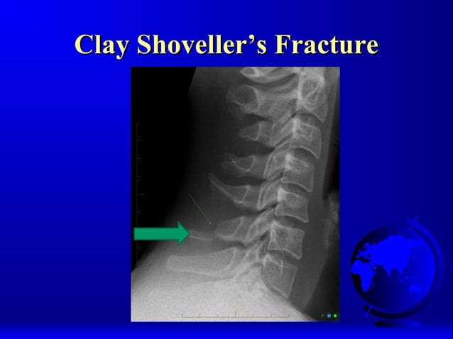 Clay shoveler's fracture | PPT