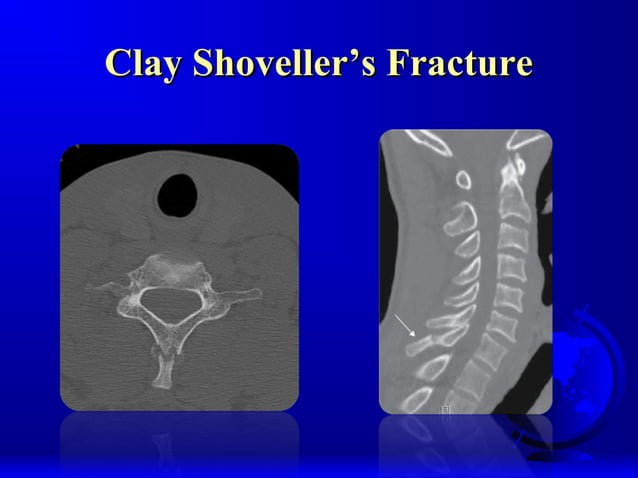 Clay shoveler's fracture | PPT