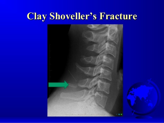 Clay shoveler's fracture