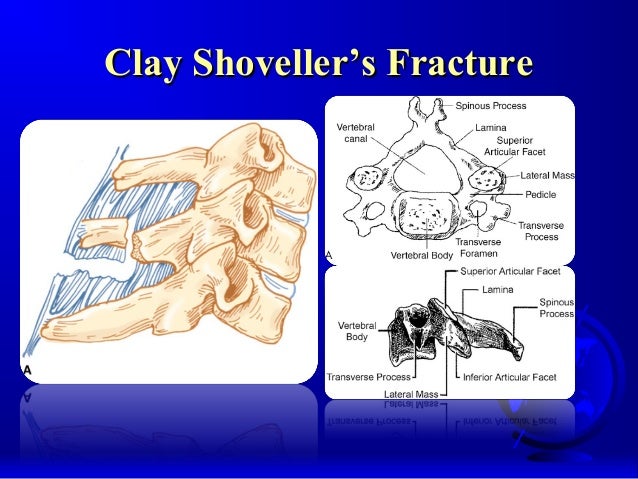 Clay shoveler's fracture