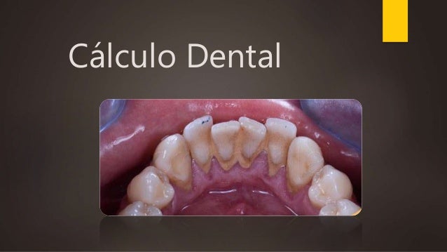 Cálculo dental Periodoncia
