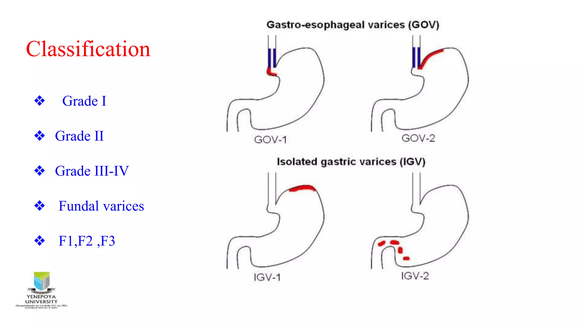 Chronic liver disease and it s complications | PPTX